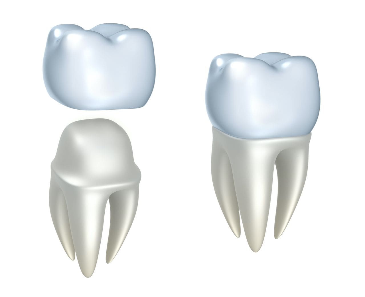 Dental Crown Procedure in Reno, NV