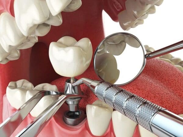 Dental Implants in Reno, NV at Dr. Teeth